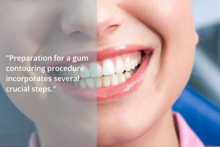 Gum Contouring Explained: What to Expect from Gum Lift Surgery ...